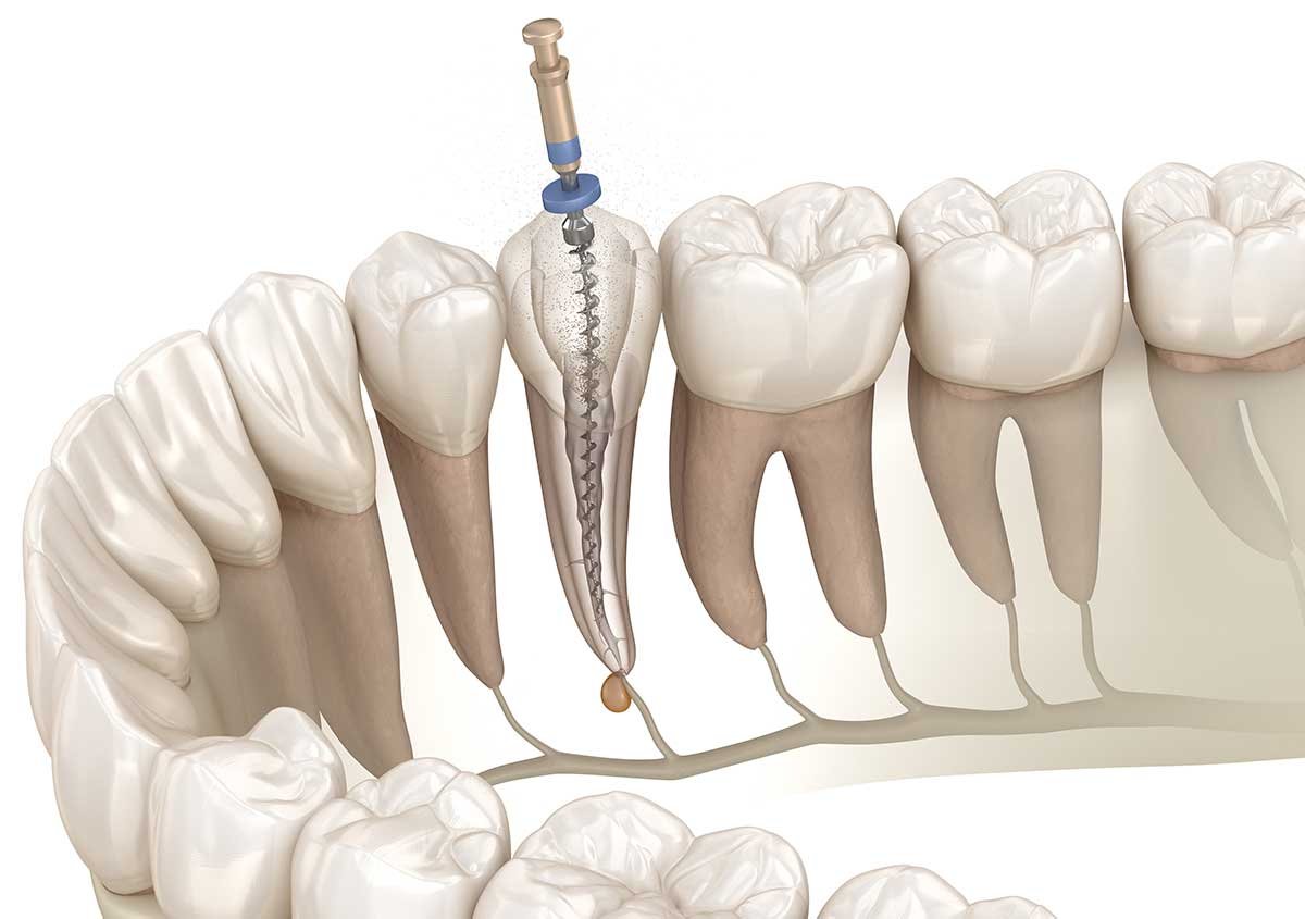 Endodontics - Thaper Dental Clinic